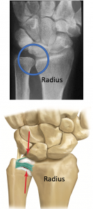 Arthroscopic Distal Ulna Wafer Resection - Thomas R. Hunt III, M.D., D.Sc.