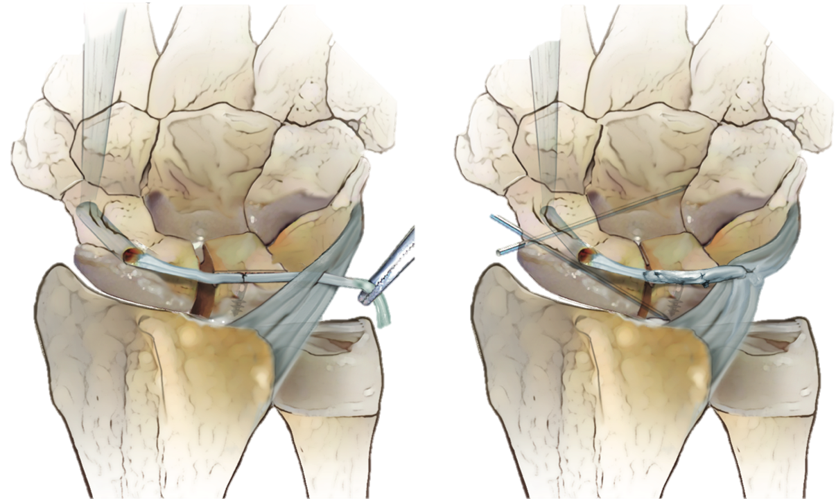 Modified Brunelli Tenodesis - Thomas R. Hunt III, M.D., D.Sc.