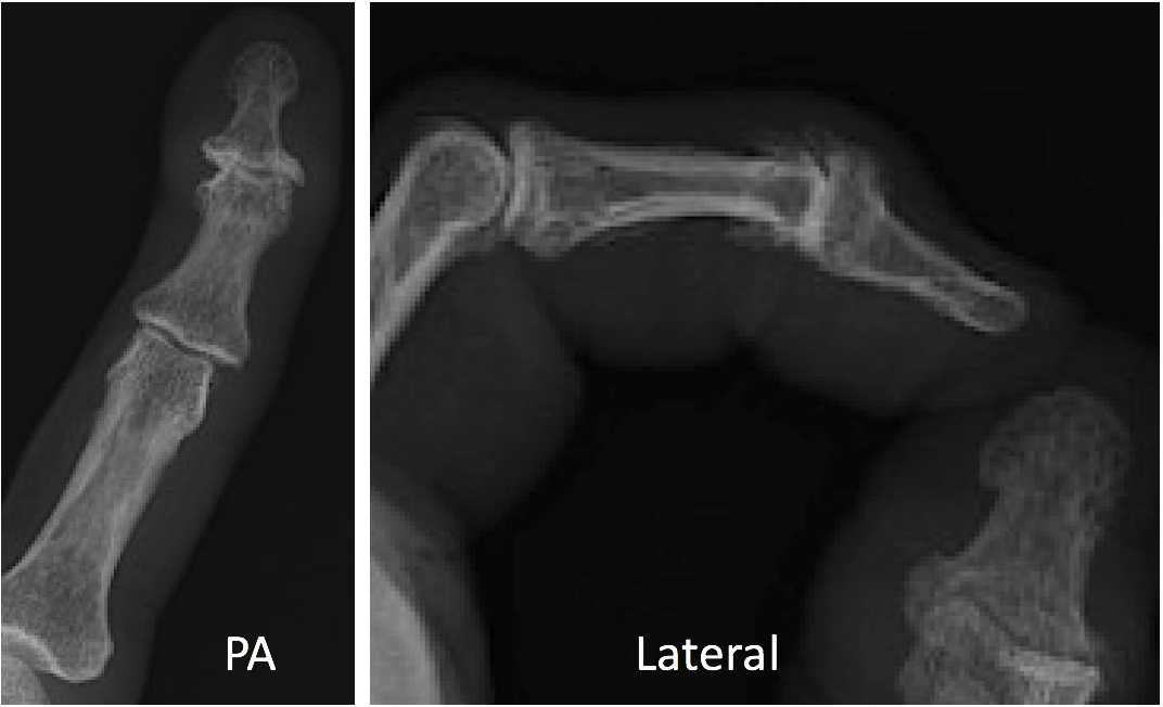 Index Finger IP Joint Fusion - Thomas R. Hunt III, M.D., D.Sc.