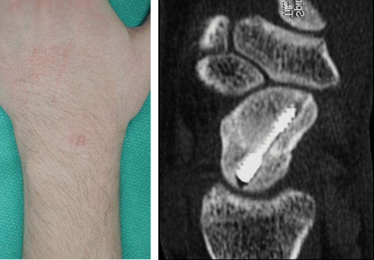 Mini-Open Reduction and Internal Fixation of Acute Scaphoid Fracture ...