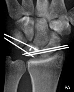 Modified Brunelli Tenodesis - Thomas R. Hunt III, M.D., D.Sc.