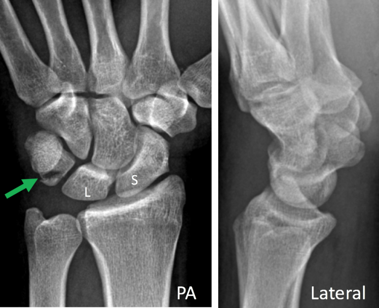 Modified Brunelli Tenodesis - Thomas R. Hunt III, M.D., D.Sc.