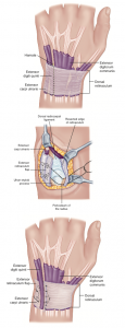 Modified Herbert Reconstruction - Thomas R. Hunt III, M.D., D.Sc.