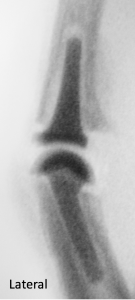 PIP Joint Pyrocarbon Implant Arthroplasty - Thomas R. Hunt III, M.D., D.Sc.