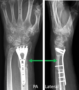 Open Reduction Internal Fixation and Bone Grafting Distal Radius ...