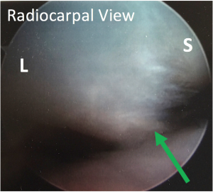 Modified Brunelli Tenodesis - Thomas R. Hunt III, M.D., D.Sc.